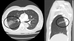 The Meaning of B-Lines | POCUS_Toronto