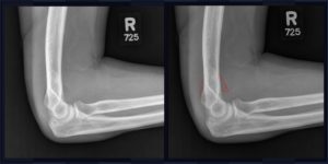 POCUS for Elbow Injuries | POCUS_Toronto