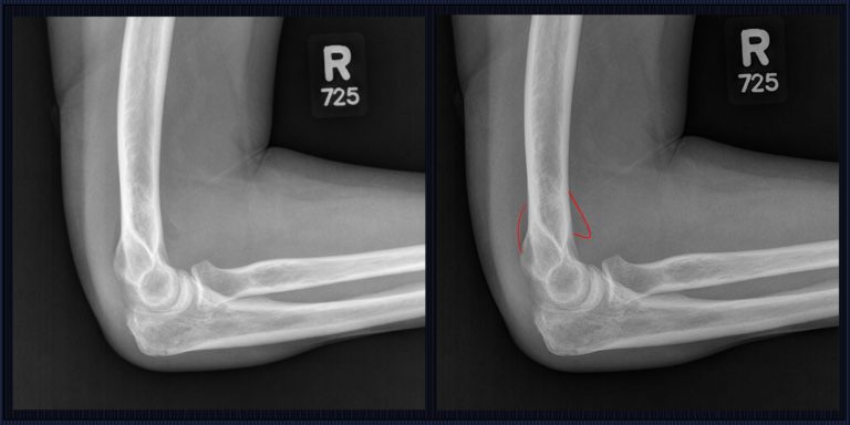 POCUS for Elbow Injuries | POCUS_Toronto